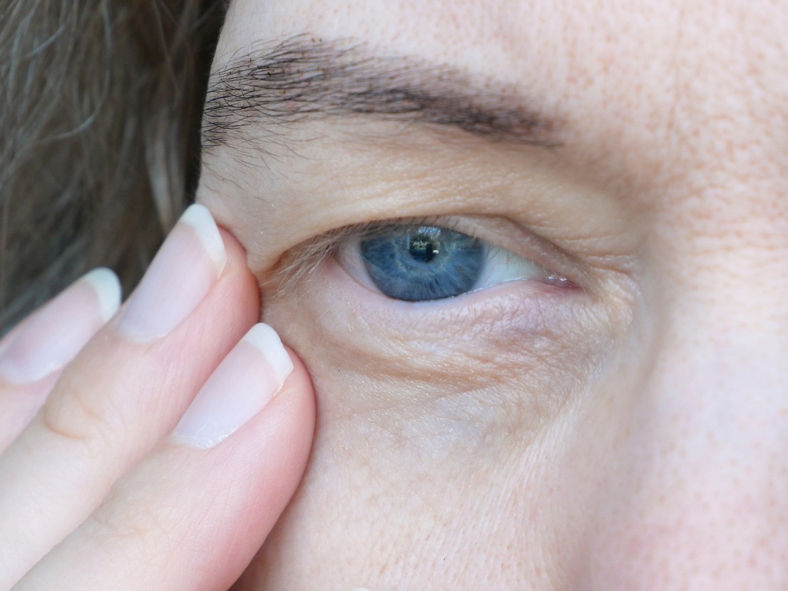 Non-Incisional Ptosis Correction Surgery