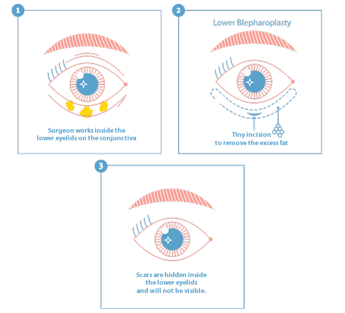 Scarless Eyebag Removal Surgery | Polaris Plastic Surgery