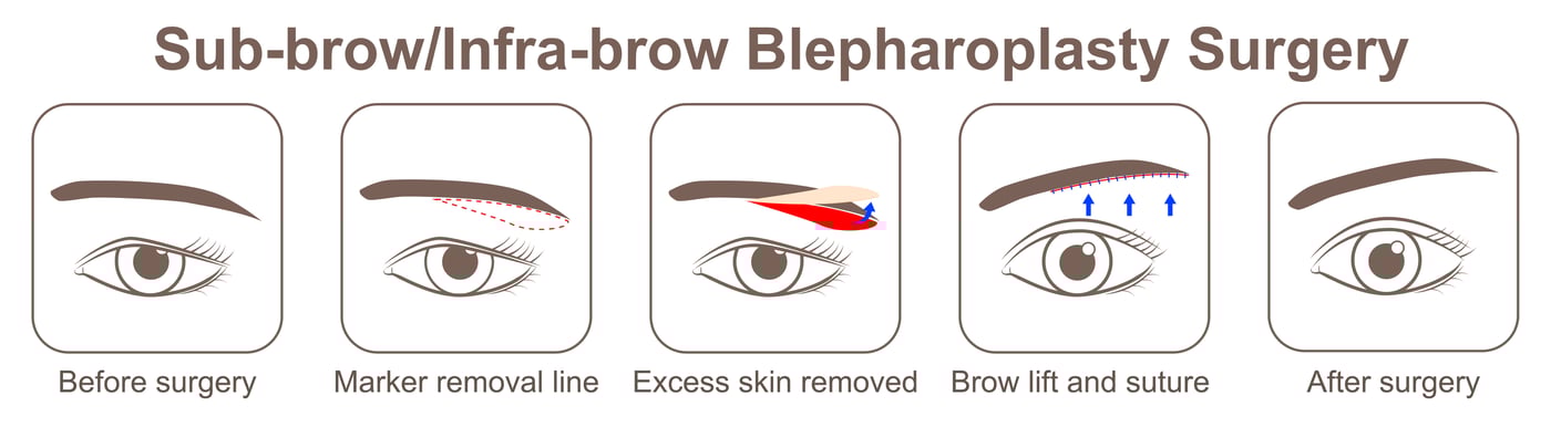 Polaris - Sub-brow/Infra-brow Blepharoplasty