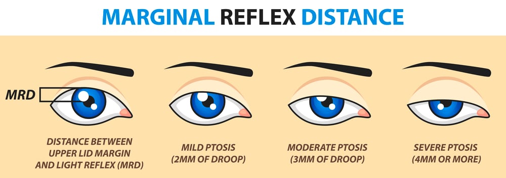 Non-Incisional Ptosis Correction Surgery